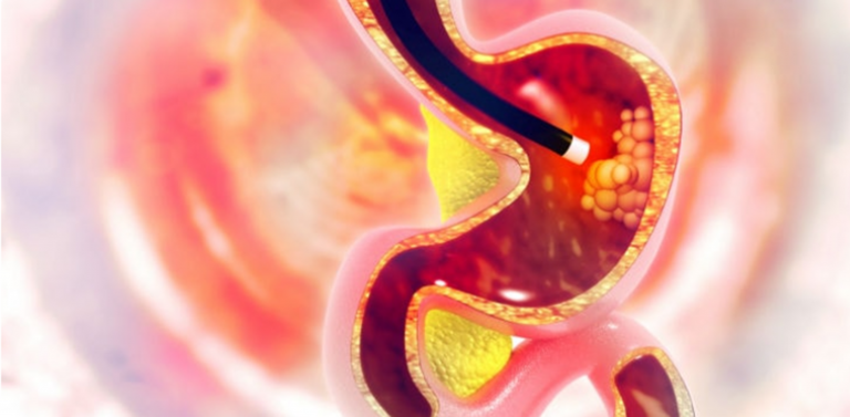 Endoscopia: O que é, como é feita e qual o preparo necessário ...